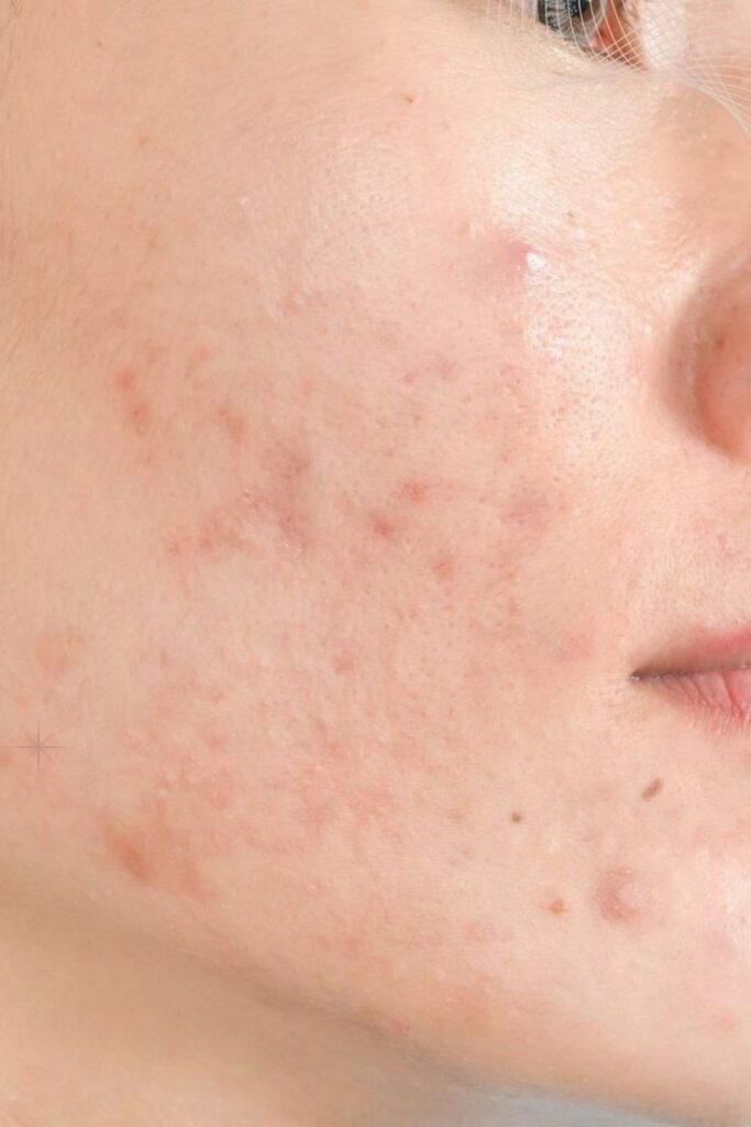 Unlock the Secret to Clearer Skin: Acne Types and Targeted Treatments