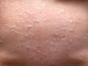 Whiteheads: The Ultimate Guide to Clearing Your Skin and Preventing ...